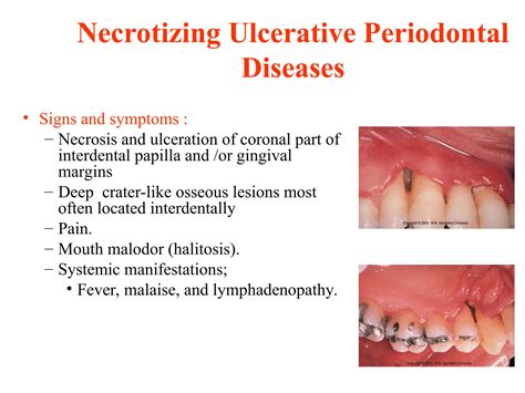 Periodontal Diseases Iiippt Classification Ppt