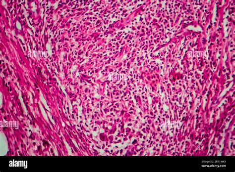 Non Hodgkins Lymphoma Light Micrograph Photo Under Microscope Stock
