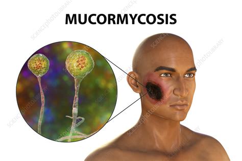 Cutaneous Mucormycosis Illustration Stock Image F0333634