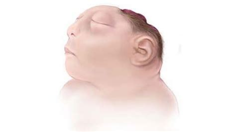 Anencephaly Birth Defects Cdc