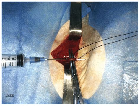 The Cynomolgus Monkey Model Of Carotid Atherosclerosis Was Constructed