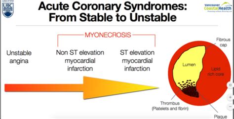 Aandc 2 Exam 2 Cardiac Circulation Mi Angina Cad Nstemi Stemi Flashcards Quizlet