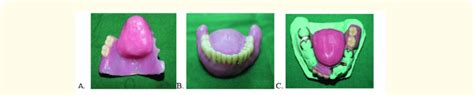 Figure Showing A Palatal Augmentation Prostheses B And C Are Download Scientific Diagram