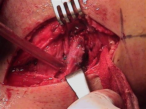 Fibular Collateral Ligament Repaired Arizona Institute For Sports