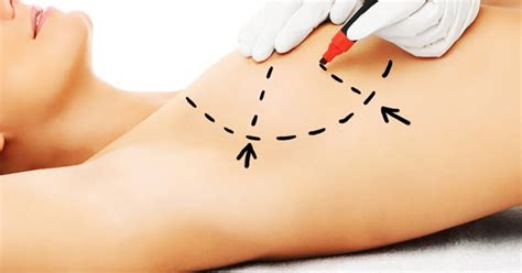 What Are Breast Tissue Expanders And How Are They Used In Breast