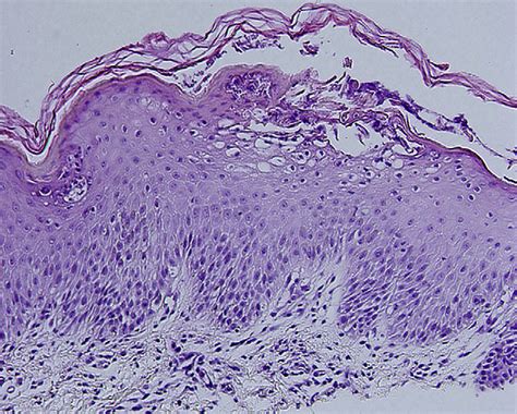 Epidermis Reveals Hypogranulosis Accumulation Of Polymorphs Within The