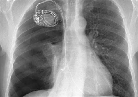 Additional Research Images Pocket Hematoma