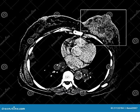 Breast Cancer Ct Scan Image Isolated Stock Images Image 21133784