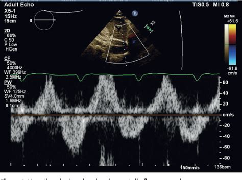 Figure 2 From Unusual Cause Of Hepatic Vein Systolic Flow Reversal