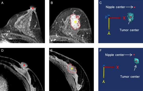 Breast Tumor Movements Analysis Using Mri Scans In Prone And Supine