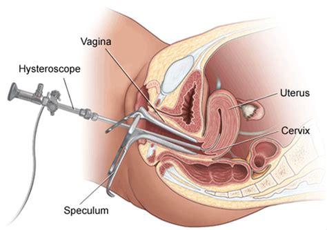 Uterine Polyps Removal