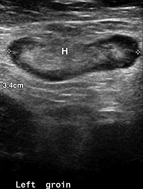 Reactive Lymph Node In A 51 Year Old Man With Lower Extremity
