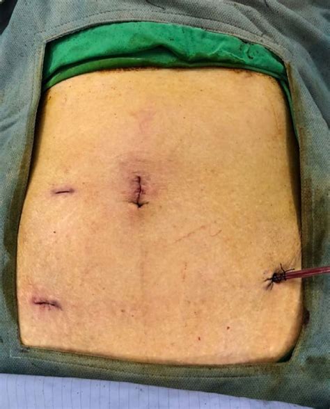 Appearance Of The Abdomen After Laparoscopic Sigmoid Colectomy With