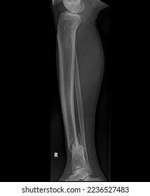Compound Tibial Fracture Male Patient Alignment Stock Photo Shutterstock