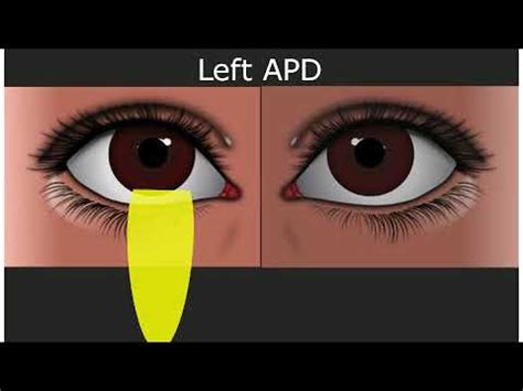 Afferent Pupillary Defect 1simspupils And Cranial Nerves
