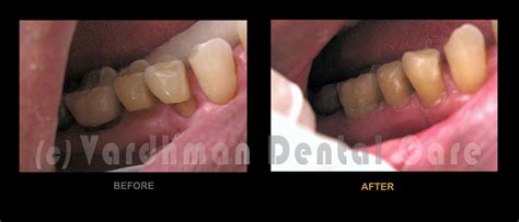 Abrasion Abfraction Correction Mr Ccjul10vdcimg96949694