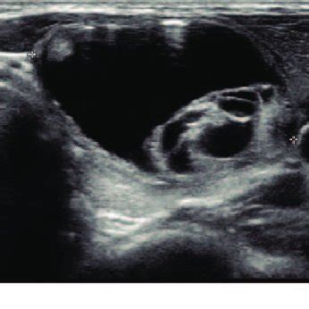 An Example Of A Mixed Echoic Nodule With An Eccentric Solid Portion And Download Scientific