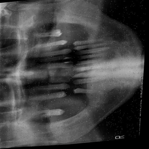 Tooth Object Detect Object Detection Dataset By Teeth Annotate