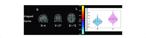 Group Differences Of The Whole Brain Functional Connectivity Anchored