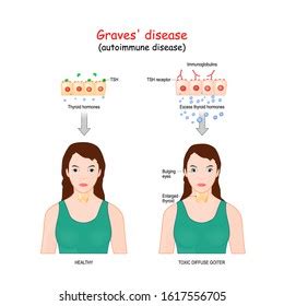 Graves Disease Toxic Diffuse Goiter Autoimmune Stock Vector Royalty Free Shutterstock