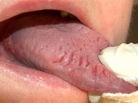 Cracked Tongue Definition Causes Symptoms And Treatment