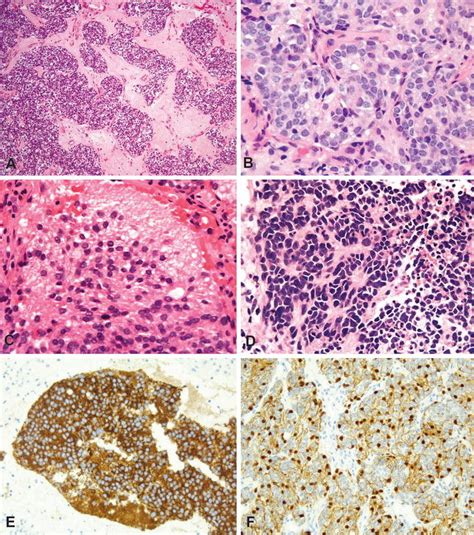 Low Grade Onb Composed Of Individual And Confluent Nests Of Small Round