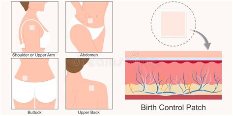 Birth Control Patch Stock Illustrations 173 Birth Control Patch Stock