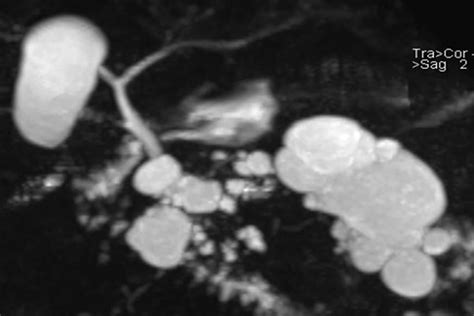 Diffuse Intraductal Papillary Mucinous Neoplasia In Both Nat Acg