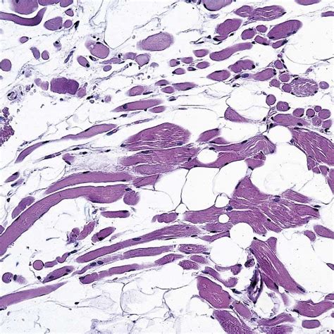 Pdf Infiltrating Intramuscular Lipoma Of The Temporal Muscle A Case Report With Molecular