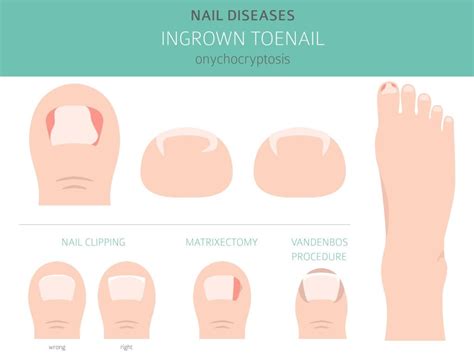 Ingrown Toenail Surgery An Overview Of The Process Cost Recovery