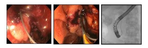 Successful Eus Guided Rendezvous Ercp World Endoscopy Organization