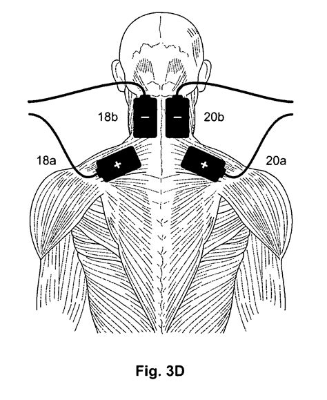 Ifc Electrode Placement Neck At Richard Montejano Blog