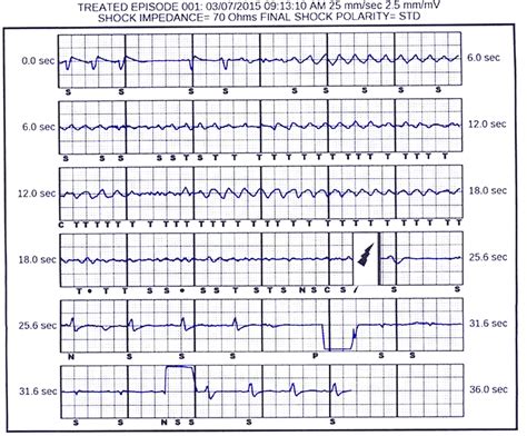 Subcutaneous Implantable Cardioverter Defibrillator S Icd Conversion