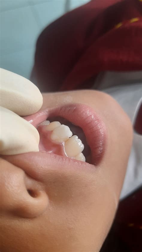 Bill The Butcher Reconstruction Of A Fractured Maxillary Central Incisor