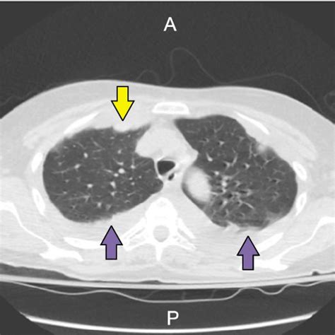 Pleural Fluid Cytology Revealing Numerous Atypical Plasmacytoid Cells