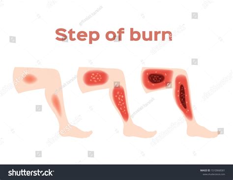 Illustration Of Burn Depth