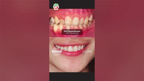 Gio Dental Braces Striving For Alignment Without Overlpse Youtube