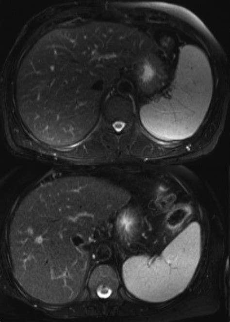 Advanced Mri Methods For Assessment Of Chronic Liver Disease Ajr