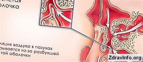 Simptomi I Liječenje Akutne Edematozno Catarrhal Sinusitis 👃 Portal