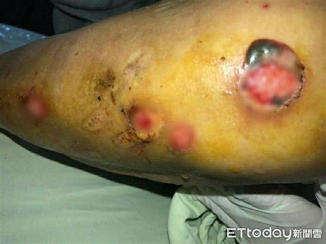 全身冒水泡流膿！家中長者患「類天皰瘡」常被誤認燙傷 Ettoday健康雲 Ettoday新聞雲