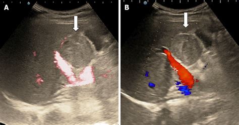 Hepatic Hemangioma Ultrasound