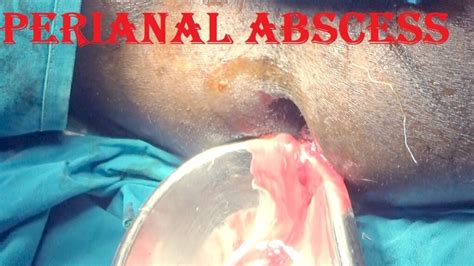 Anal Abscess Surgery What To Expect Ask The Nurse Expert