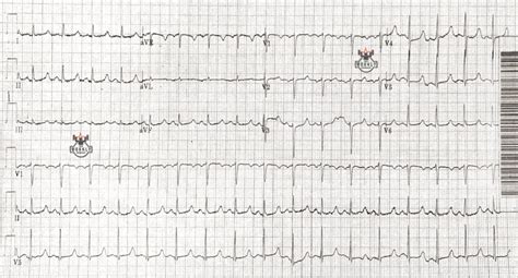 Ecg Basics And Fundamentals Causes Of Prolonged St Segment Ecg Weekly