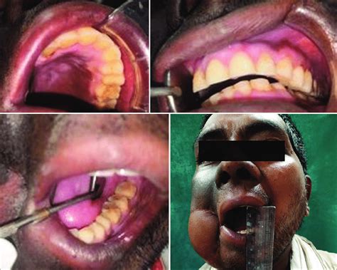 Mandibular Deviation And Maximum Mouth Opening Download Scientific