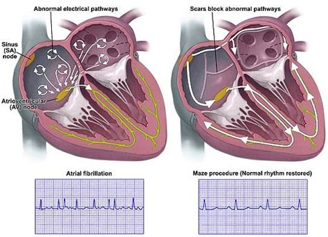 Schematic Illustration Of Atriotomy Scar Lesions Blocking Abnormal