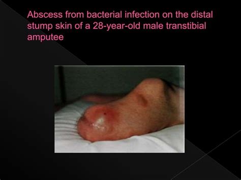 Complications After Amputation Pptx