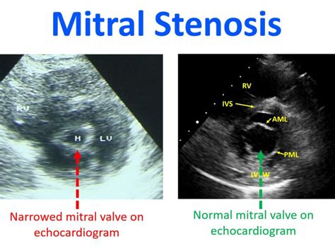 Mitral Stenosis All About Heart And Blood Vessels