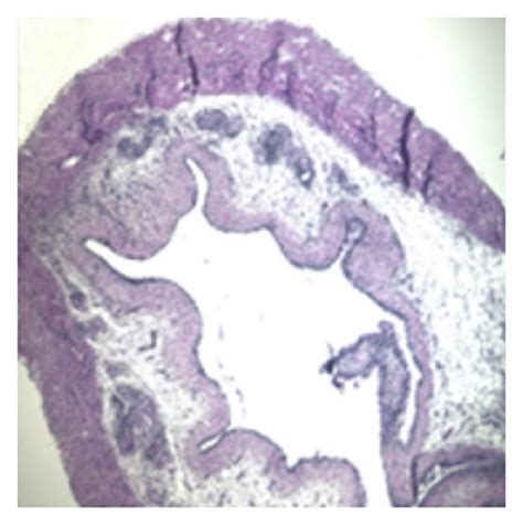 Intravesical Dmso Treatment Reduces Bladder Histopathology In Chronic