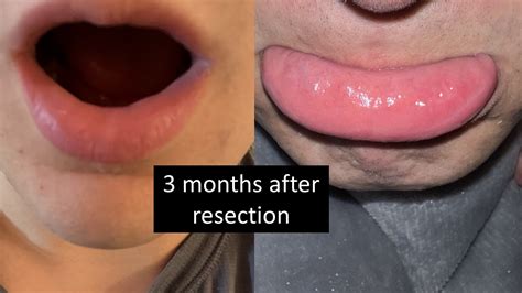 Lower Lip Bump Mucocele Versus Mucus Retention Cyst Minor Salivary