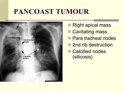 Chest X Ray Pathology PPT Lung And Respiratory Health Diseases And Conditions